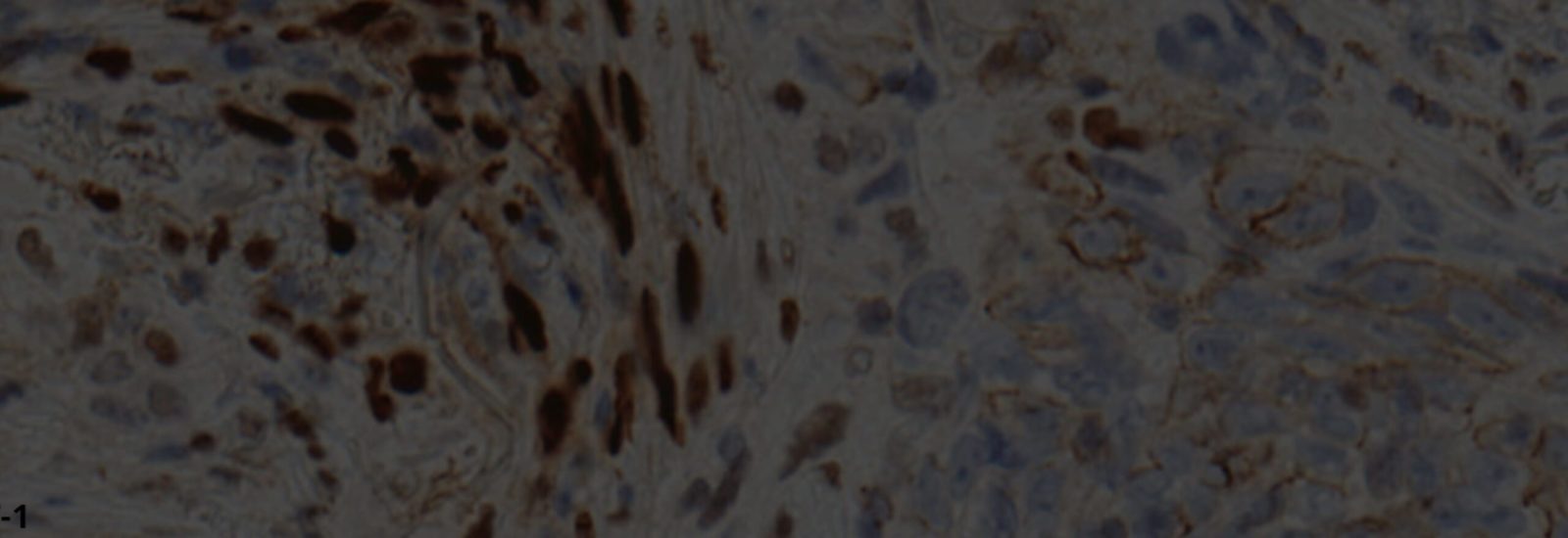 Clinical Proteomic Tumor Analysis Consortium – PBC VAI